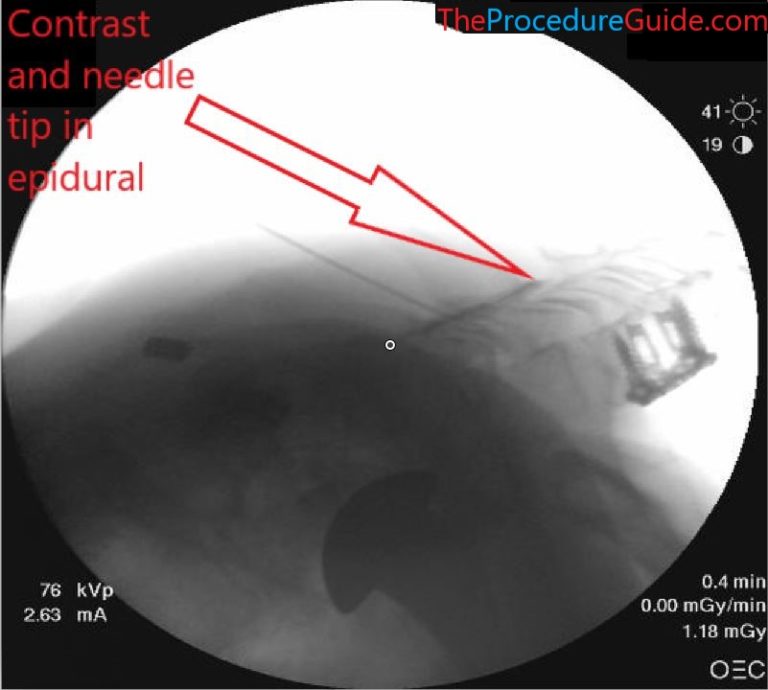 Fluoroscopic Guided Sitting Cervical Interlaminar (Midline) Epidural ...