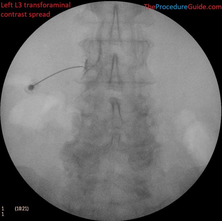 Fluoroscopic Guided Thoracic/Lumbar Transforaminal Epidural Steroid ...