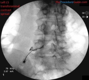 Fluoroscopic Guided Thoracic/Lumbar Transforaminal Epidural Steroid ...