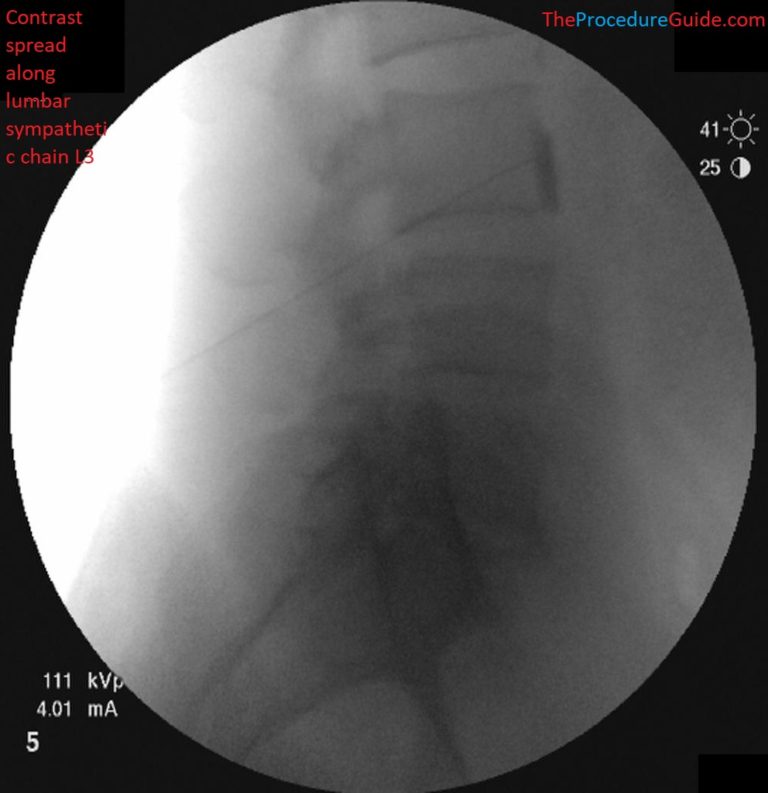 Lumbar Sympathetic Block - Technique and Overview - The Procedure Guide