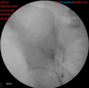Fluoroscopic Guided Sacroiliac (SIJ) Joint Injection – Technique and ...