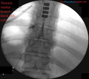 Fluoroscopic Guided Thoracic Medial Branch Block - Technique and ...