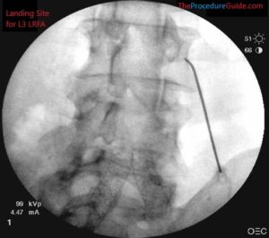 Fluoroscopic Guided Sacroiliac (SIJ) Joint Dorsal Ramus and Lateral ...