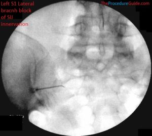 Fluoroscopic Guided Sacroiliac (SIJ) Joint Dorsal Ramus and Lateral ...