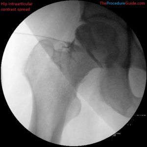 Fluoroscopic Guided Hip Joint Injection - Technique and Overview - The ...