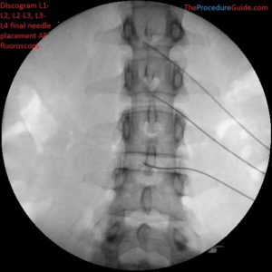 Fluoroscopic Guided Provocative Discogram/Discography – Technique and ...