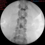 Fluoroscopic Guided Provocative Discogram/Discography – Technique and ...