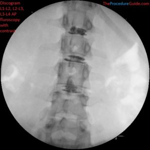 Fluoroscopic Guided Provocative Discogram/Discography – Technique and ...
