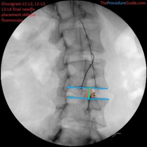 Fluoroscopic Guided Provocative Discogram/Discography – Technique and ...