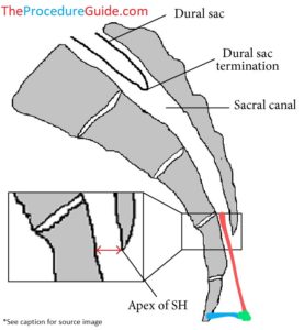 Fluoroscopic Guided Caudal Epidural Steroid Injection – Technique and ...