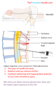 Intrathecal Access/Injection (Spinal) – Technique and Overview - The ...