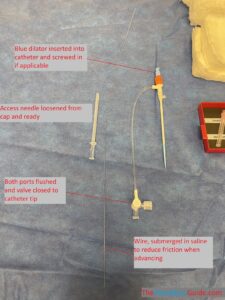 Ultrasound Guided Seldinger Venous Access – Technique and Overview ...