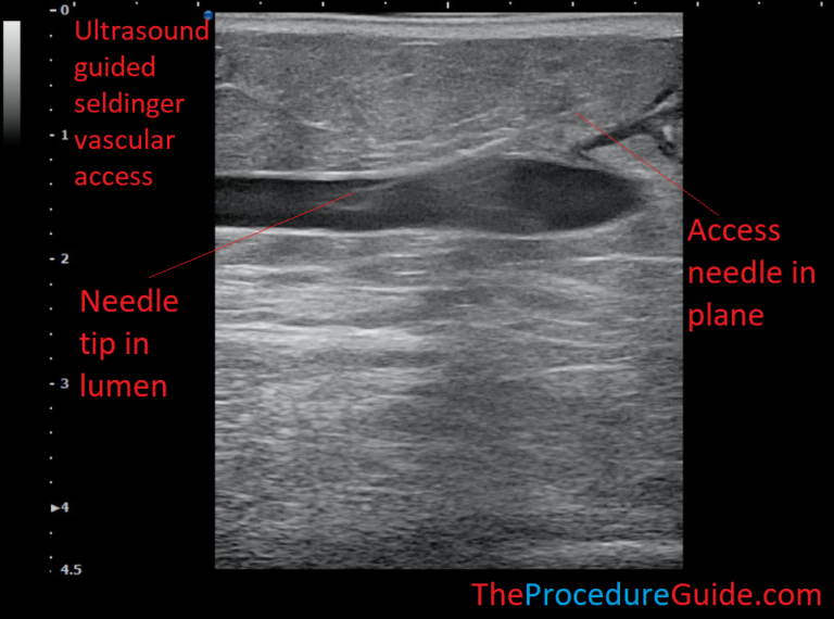 Ultrasound Guided Seldinger Venous Access – Technique and Overview ...