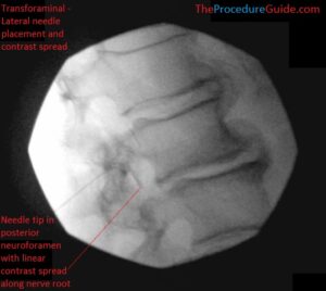 Fluoroscopic Guided Thoracic/Lumbar Transforaminal Epidural Steroid ...