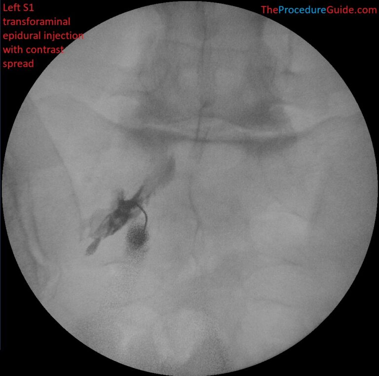 Fluoroscopic Guided Sacral Transforaminal Epidural Steroid Injection - Technique and Overview ...