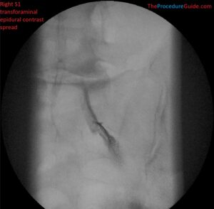 Fluoroscopic Guided Sacral Transforaminal Epidural Steroid Injection ...
