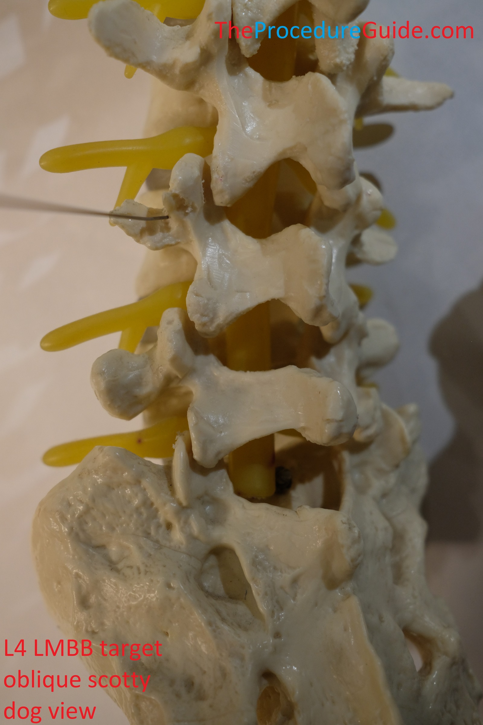 Fluoroscopic Guided Lumbar Medial Branch Block (LMBB) - Technique and ...