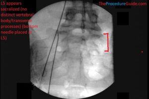 Lumbar Spine Fluoroscopic Anatomy for the Pain Management ...