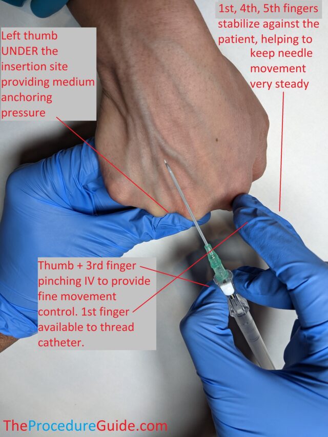 Peripheral Intravenous Access (IV) – Technique and Overview - The Procedure Guide