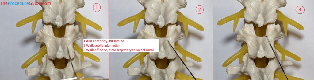 Lumbar/Thoracic Epidural Catheter Insertion – Technique and Overview ...