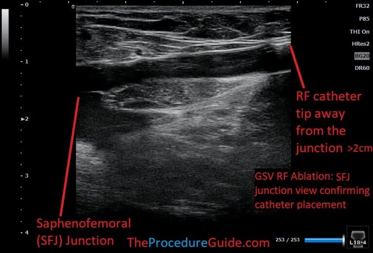 Venous Radiofrequency Ablation - Technique and Overview - The Procedure ...
