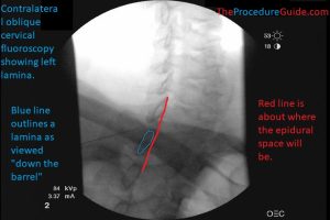 Fluoroscopic Guided Contralateral Oblique Cervical Interlaminar ...