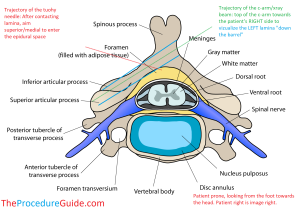 Fluoroscopic Guided Contralateral Oblique Cervical Interlaminar ...