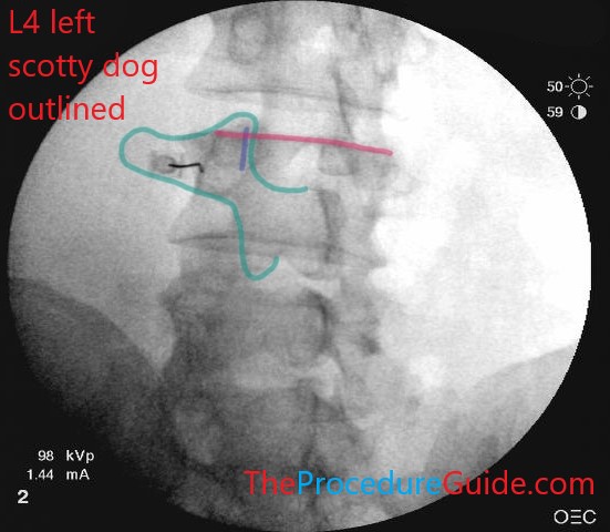 Fluoroscopic Guided Lumbar Medial Branch Block - Technique and Overview - The Procedure Guide
