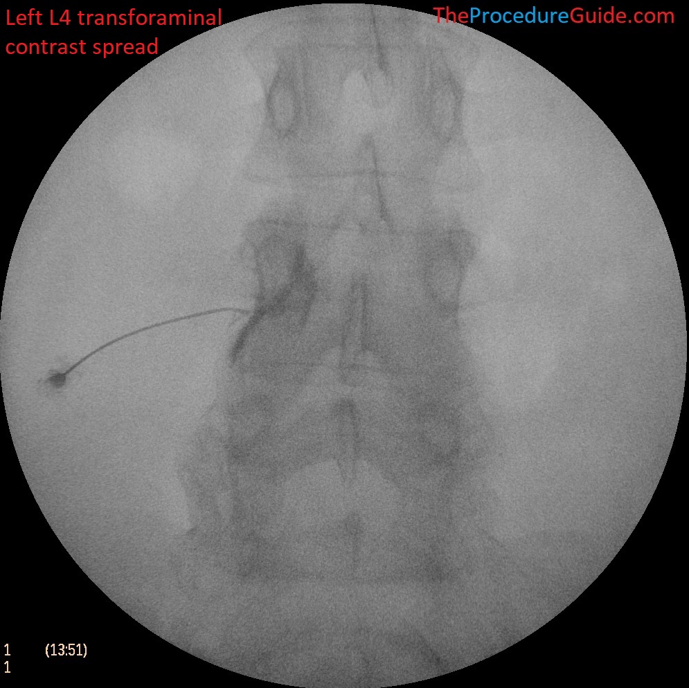 Fluoroscopic Guided Lumbar Medial Branch Block (LMBB) - Technique and ...