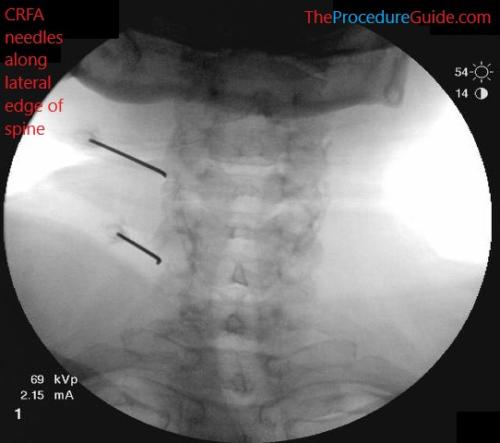 Fluoroscopic Guided Lumbar Medial Branch Block (LMBB) - Technique and ...