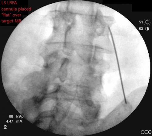 Fluoroscopic Guided Lumbar Medial Branch Block (LMBB) - Technique and ...