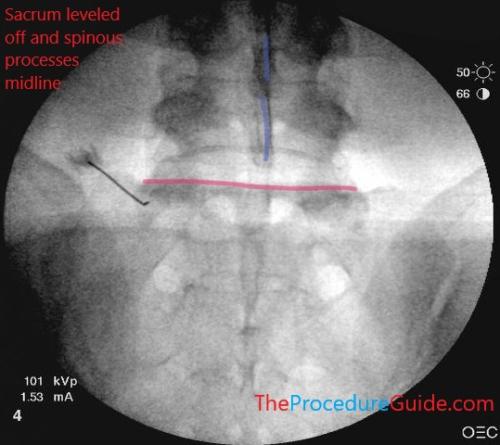 Fluoroscopic Guided Lumbar Medial Branch Block - Technique and Overview - The Procedure Guide
